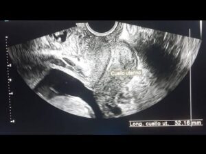 Cervicometria – Fetal Imagen